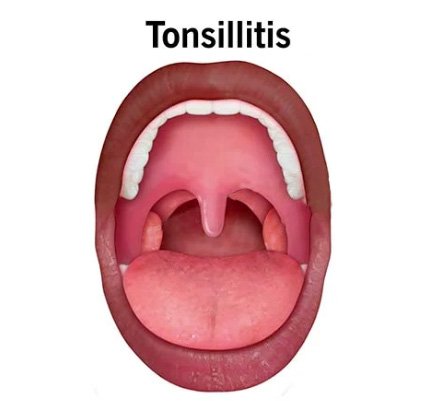 An Effective Tonsillitis Cure with MR7 Tonsillitis Treatment - MR7
